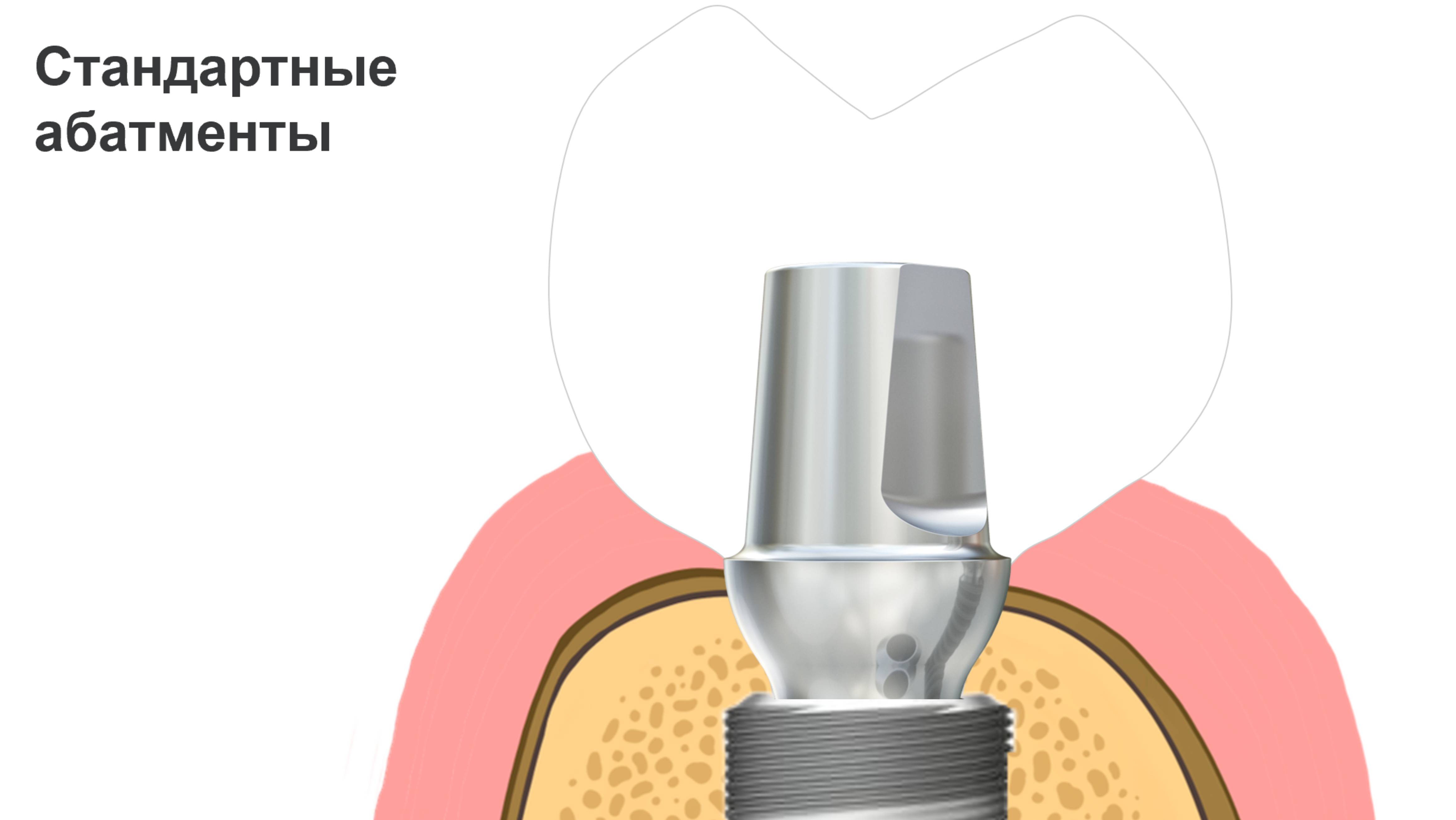 Использование стандартных абатментов Медентика(Medentika) в ExoCad