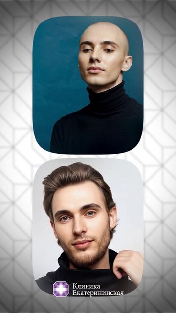 Мужская пересадка волос: до/после