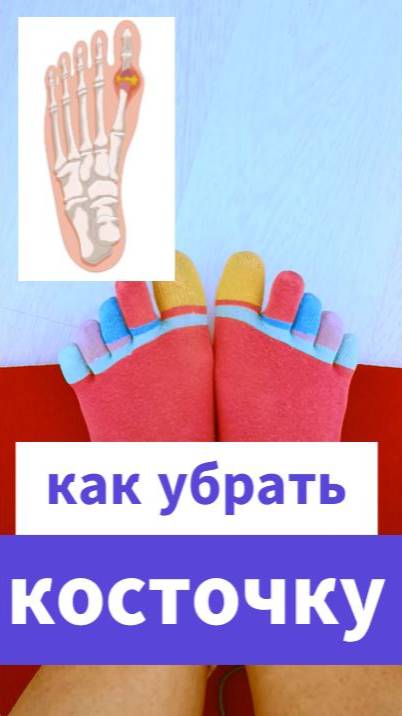 Как убрать косточку на ноге