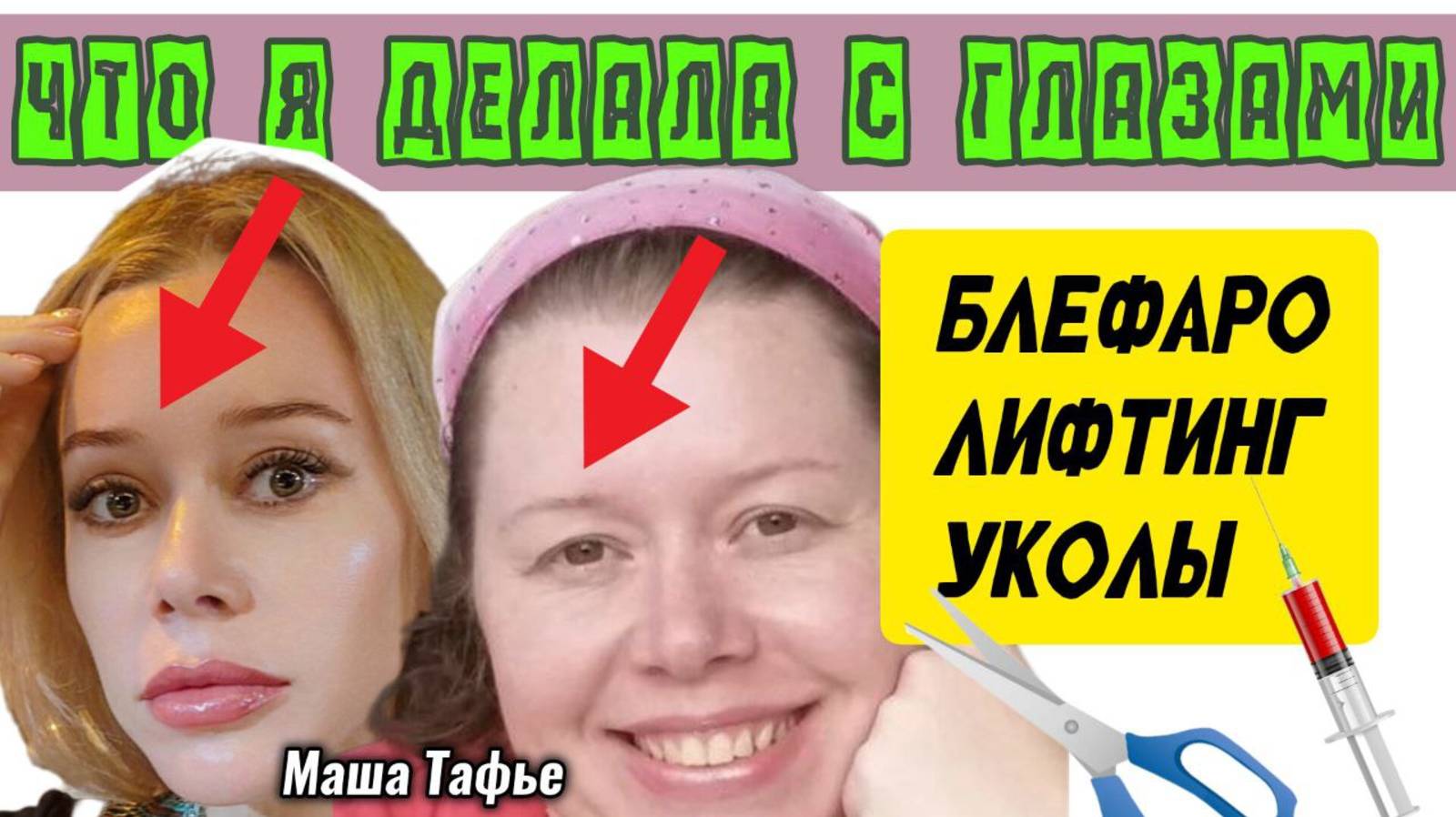 Что я делала с глазами: блефаро, лифтинг, уколы. Весна с Машей 🌷 Видео №78