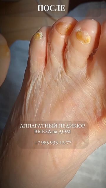 УТОЛЩЕННЫЕ НОГТИ
АППАРАТНЫЙ ПЕДИКЮР 
ВЫЕЗД на ДОМ 

+7 985 933-12-77