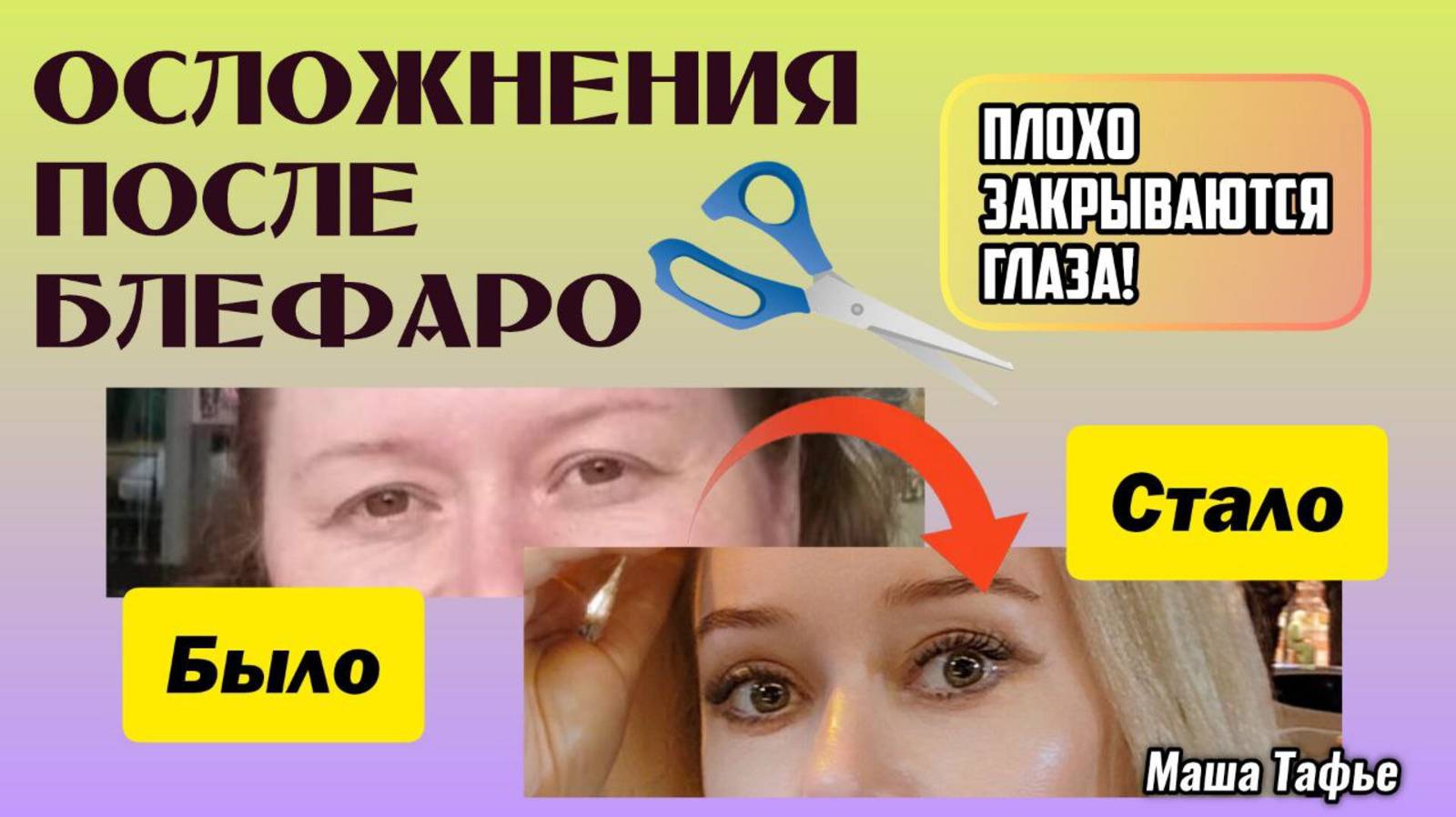 Осложнения после блефаро. Плохо закрываются глаза! Весна с Машей 🌷 Видео №79