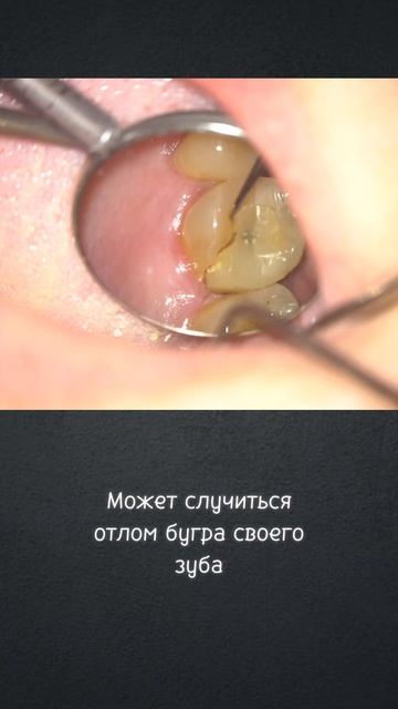 Что будет, если не ставить коронку?