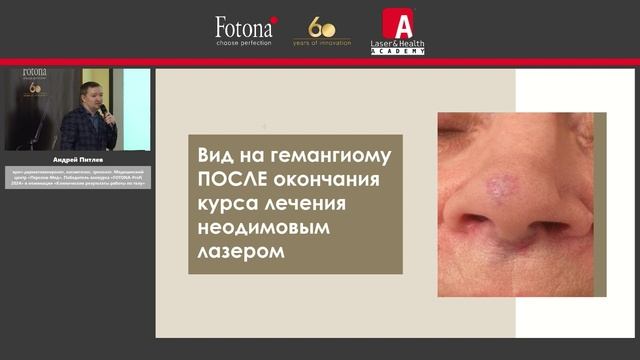 Интересные кейсы в лечении сосудистой патологии аппаратом Fotona Dynamis. Питлев А. И.