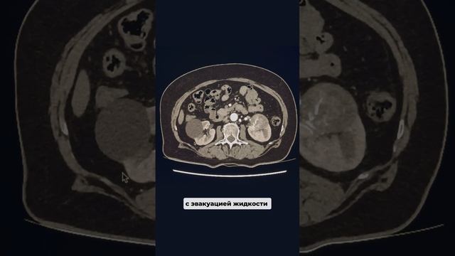 Опухоль обеих почек на компьютерной томограмме