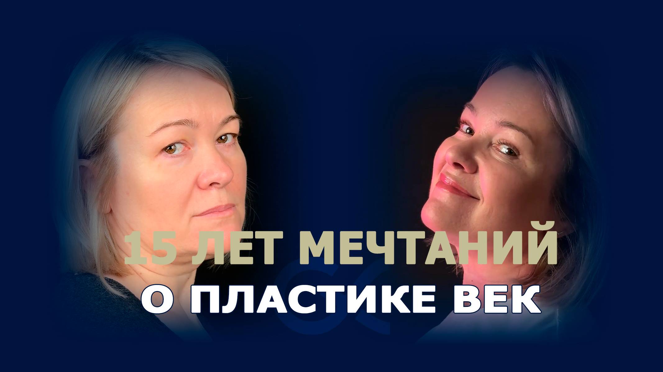 Пластика верхних век и лифтинг лба: результат без фильтров