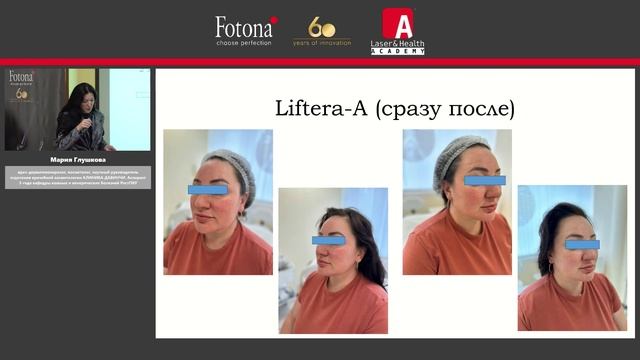 Шея, субментальная зона. Омоложение с помощью Fotona, Liftera-A, инъекций. Глушкова М. В.