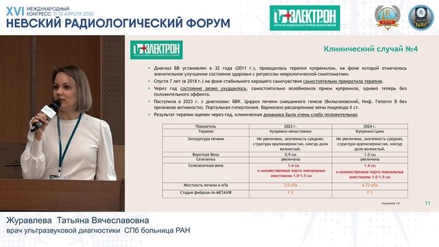 Эластометрия печени при болезни Вильсона-Коновалова. Очевидное и невероятное