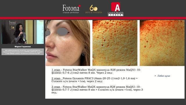 Многообразие сочетаний. Fotona Dynamis, Fotona StarWalker MaQX, Liftera-A. Глушкова М. В.