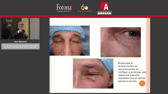 Методы лазерной коррекции эстетических проблем на лице. Матюнин О. Ю.