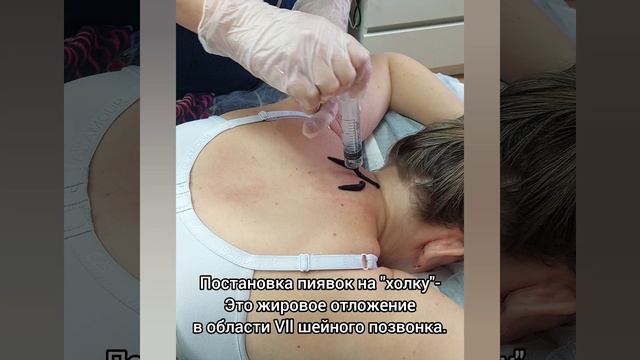 Как убрать холку/ "вдовий горбик"