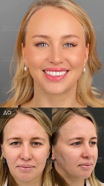 Подтяжка бровей, отзыв пациентки
