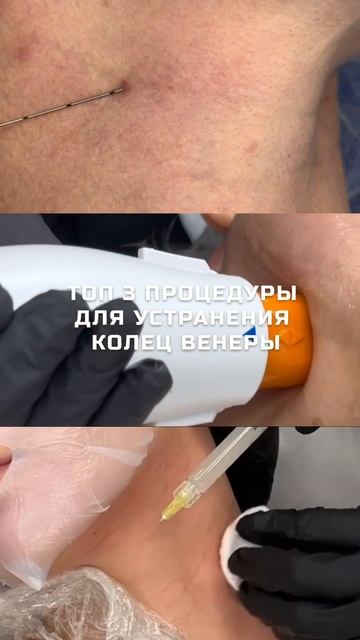 Убрать кольца Венеры один раз и навсегда!