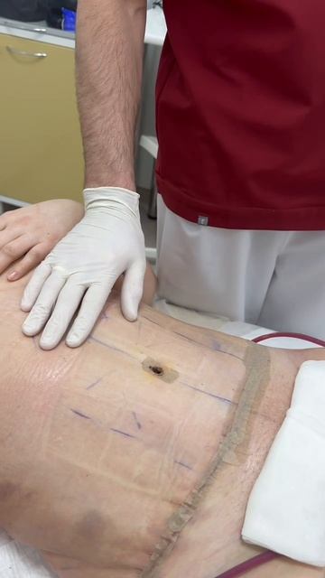 #липосакция и #абдоминопластика: первые сутки после операции