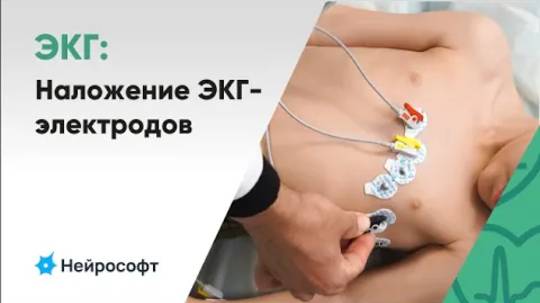 Быстрое наложение ЭКГ электродов ребенку согласно методическим рекомендациям 2023 года