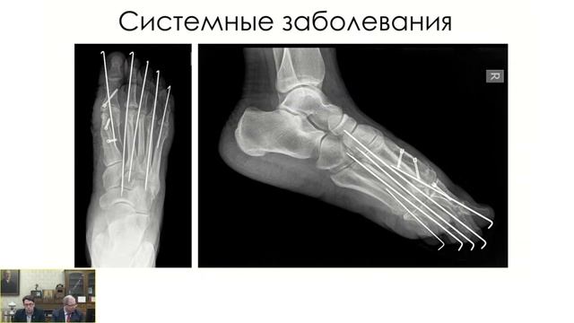 Приобретенные деформации первого плюснефалангового сустава в свете готовящихся отечественных к.р.