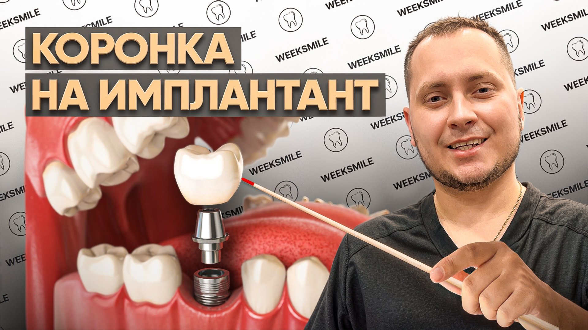 УСТАНОВКА КОРОНКИ НА ИМПЛАНТ! Очень подробно. Риски и осложнения при установке коронки на имплант