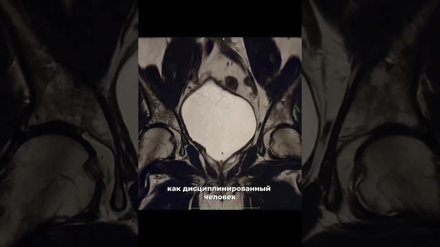 Результат лечения рака мочевого пузыря, спустя 4,5 года после простатсберающей цистрэктомии