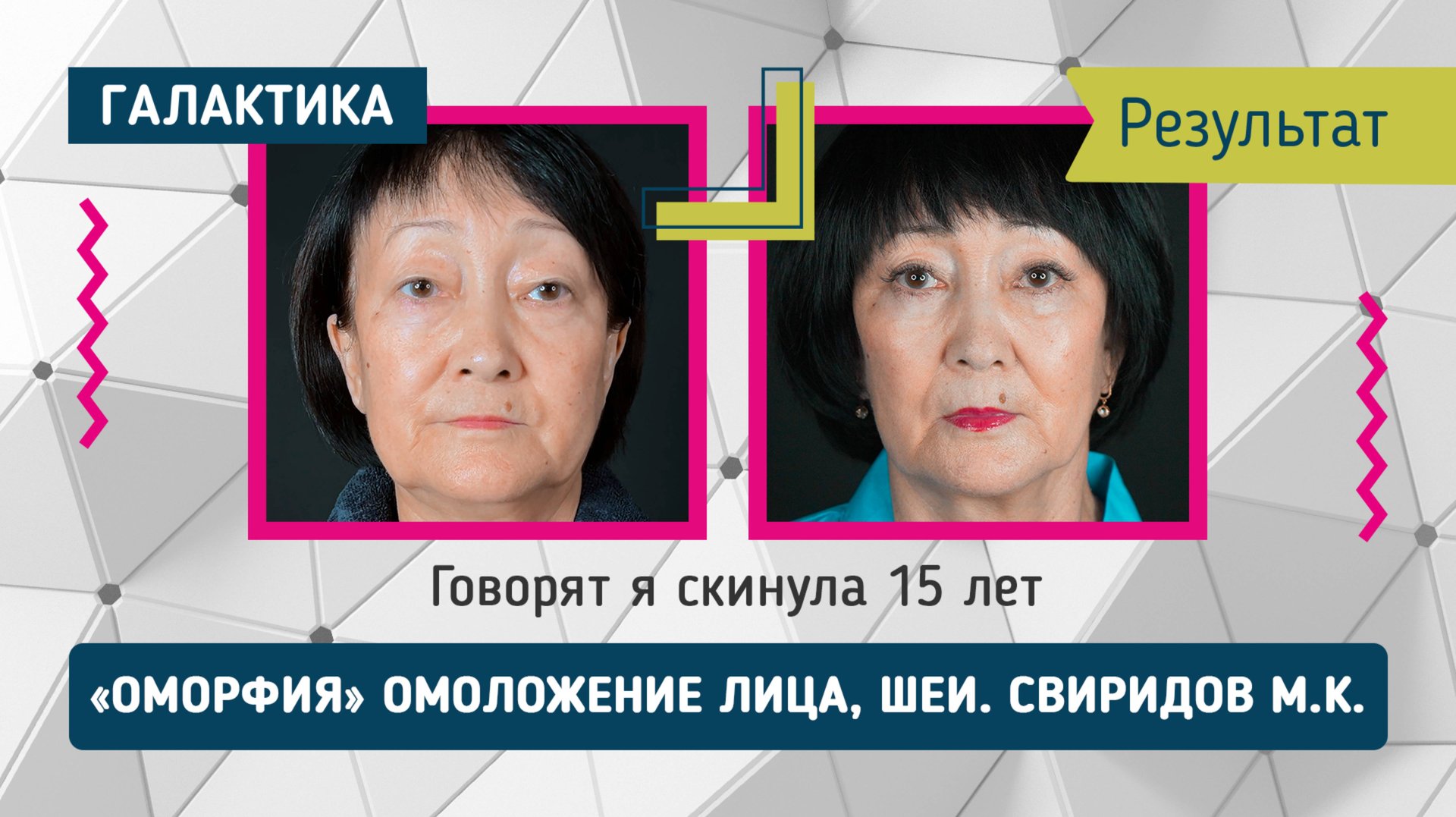 Проект «Оморфия»: омоложение лица и шеи | Результат пациентки после операции у Свиридова Максима