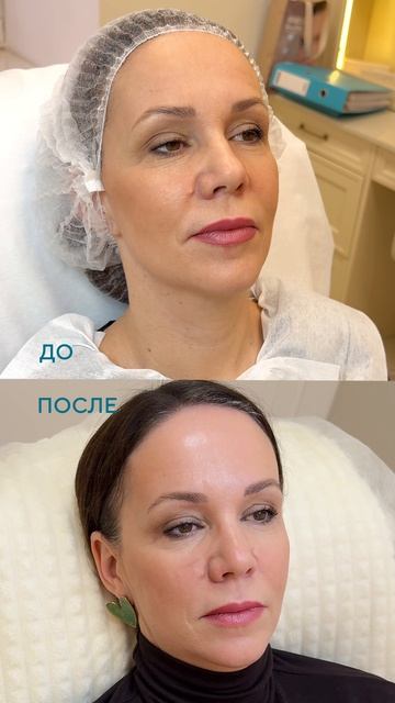ДО/ПОСЛЕ: ботулинотерапия ✨ Как избавиться от морщин?