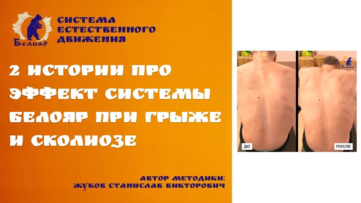 2 истории, как Белояр помог избавиться от грыжи и помогает исправить многолетний сколиоз
