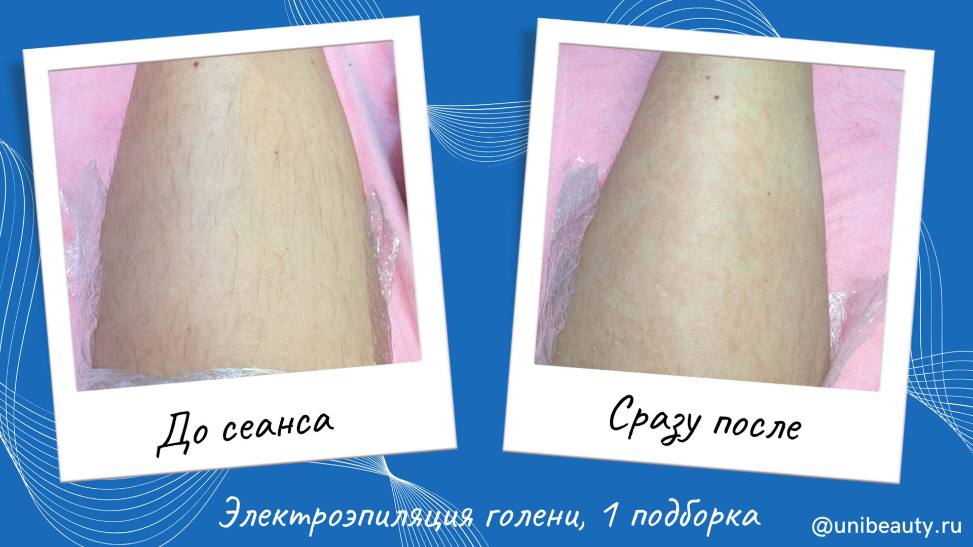 Электроэпиляция голени, 1 подборка