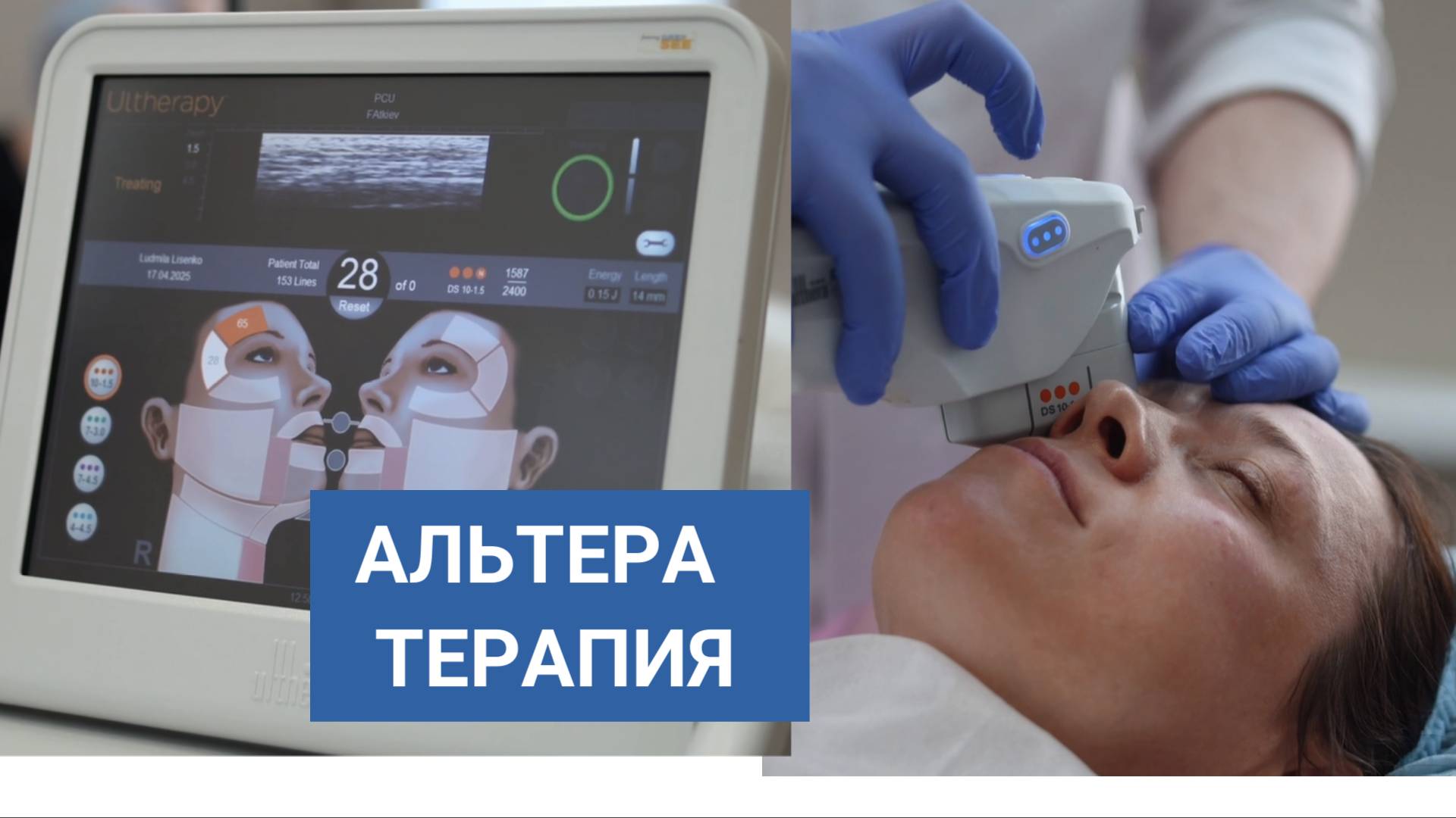 Минус 10 лет за 30 минут: что такое Альтера-терапия? #Ultherapy #ПодтяжкаЛица