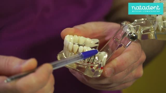 81.  Капюшон над зубом мудрости. Удалять? Натадент Стоматология