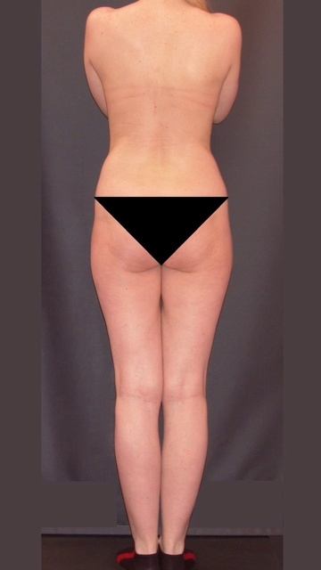 РУЧНАЯ ПЛАСТИКА ТЕЛА. ДО И ПОСЛЕ. ВИДЕО КЛИП 3.