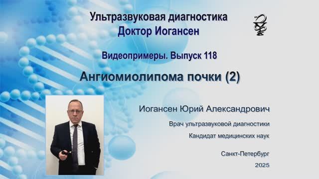 УЗИ. Доктор Иогансен. Видеопримеры. Выпуск 118. Ангиомиолипома почки (2).