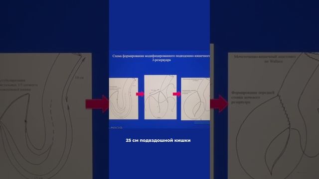 Техника операции по удалению мочевого пузыря, позволяющая сохранить важные функции