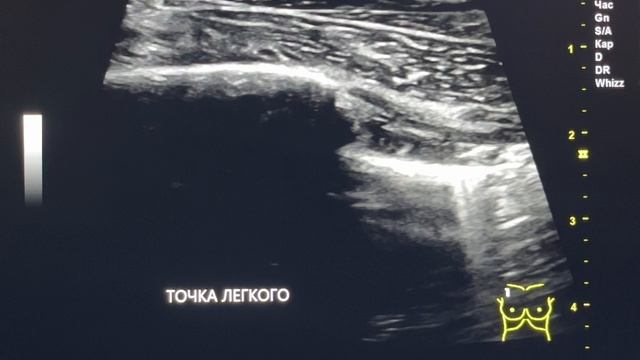 ПНЕВМОТОРАКС. Точка легкого в В-режиме
#ICU #ОРИТ #реанимация #узи #узилегких #пневмоторакс
