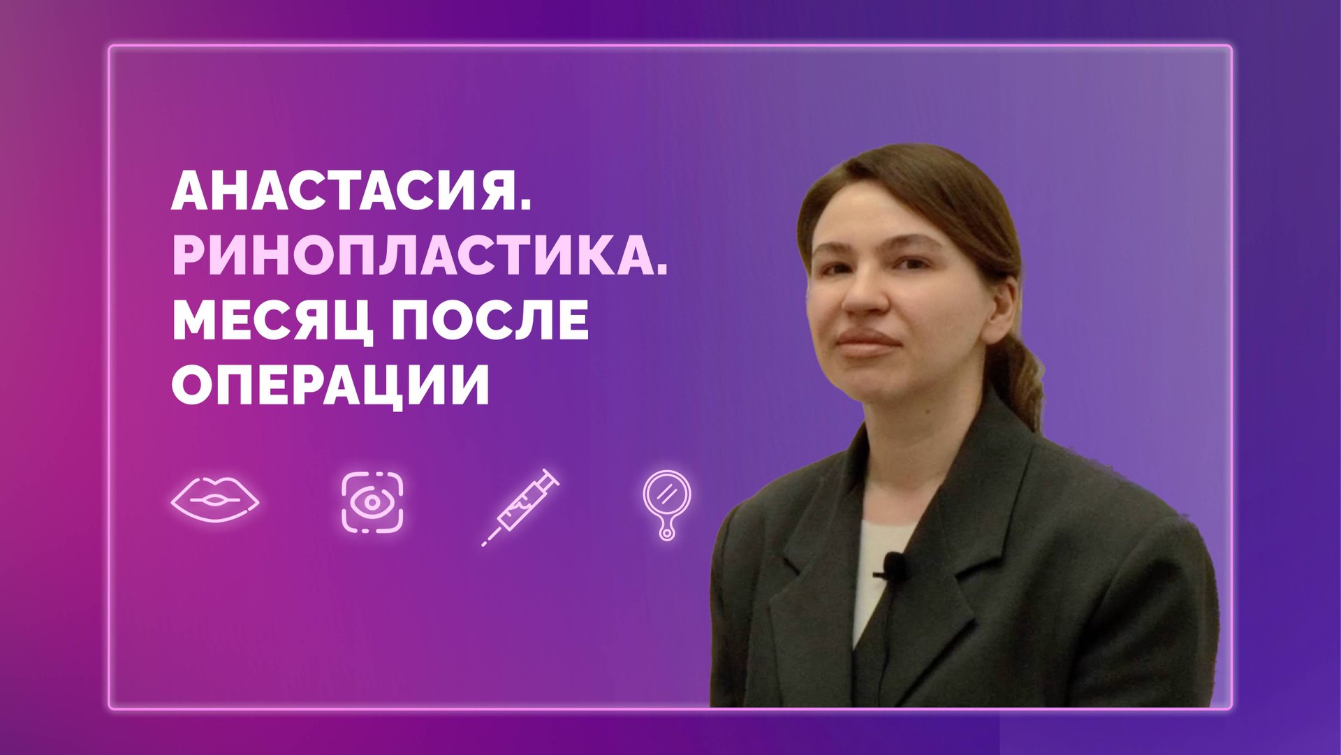 Анастасия. Ринопластика. Месяц после операции