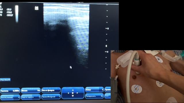 BLUE-протокол. Исследование в нижней BLUE-точке
#ОРИТ #ICU #реанимация #УЗИ #узилегких #BLUE