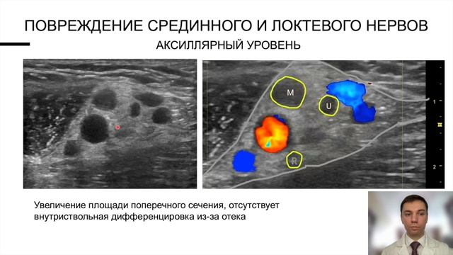 УЗИ-навигация при лечении невропатии плечевого сплетения
#painmanagement #лечениеболи #нейропатия