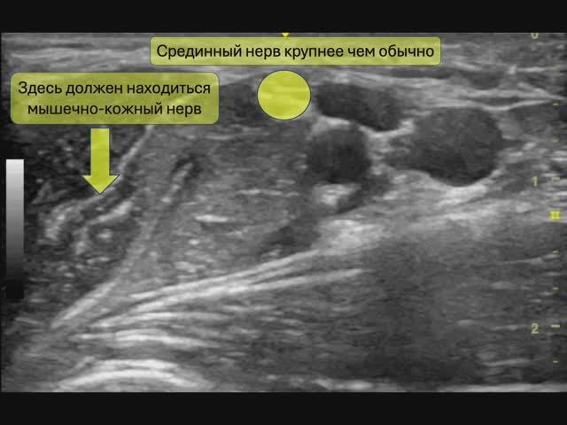 ВАРИАНТЫ СТРОЕНИЯ СРЕДИННОГО НЕРВА
#узи #нервов