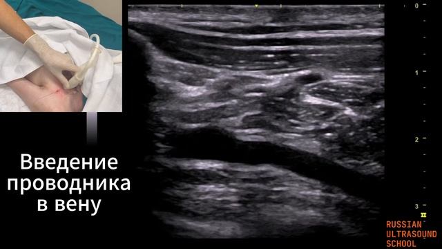 КАТЕТЕРИЗАЦИЯ ПОДКЛЮЧИЧНОЙ ВЕНЫ ПОД КОНТРОЛЕМ УЗИ
#узинавигация #сосудистыйдоступ #УЗИ #ICU #ОРИТ