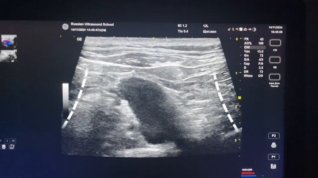 ЕЩЕ НЕСКОЛЬКО СЛОВ ПРО НАДКЛЮК
#узинавигация #сосудистыйдоступ #надклюк