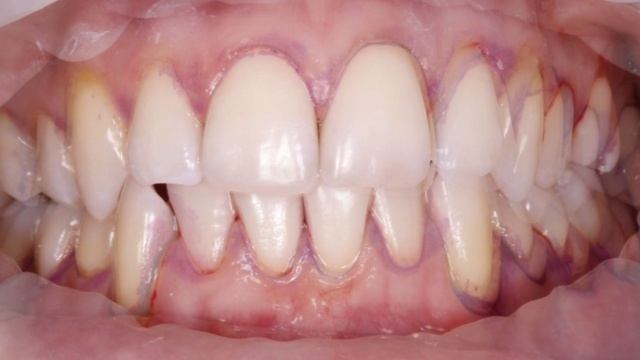 Гигиена зубов: до/после