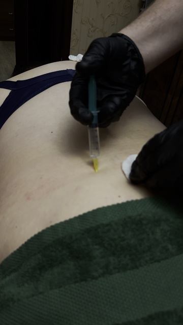 Какова суть метода фармакопунктуры и как проходит процедура?