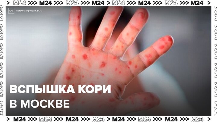 В Москве зафиксирована вспышка кори среди детей и взрослых - Москва 24