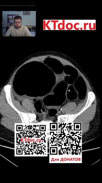 Кишечная непроходимость