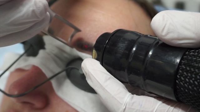 Удаление Татуажа Бровей Пиколазером (Тирасполь и Бендеры)