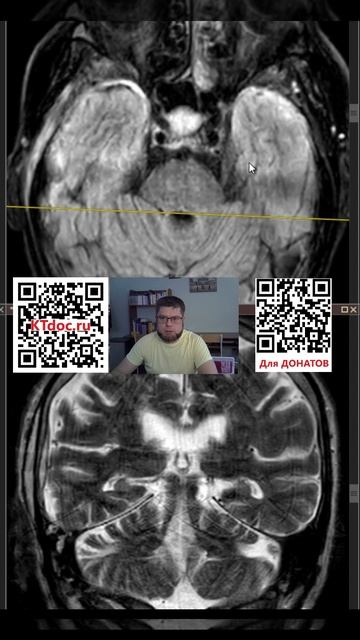 Субдуральная гематома