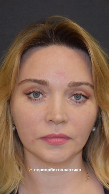 ДО/ПОСЛЕ: блефаропалстика + лобэндосокопия + срединный лифтинг