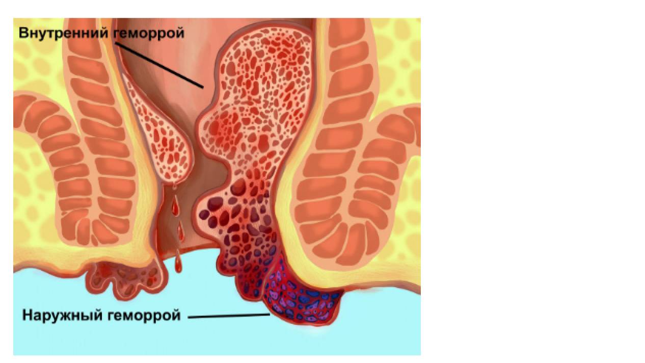 Геморрой. Избавилась за одну неделю очень просто, МАЗЬ ВИШНЕВСКОГО.