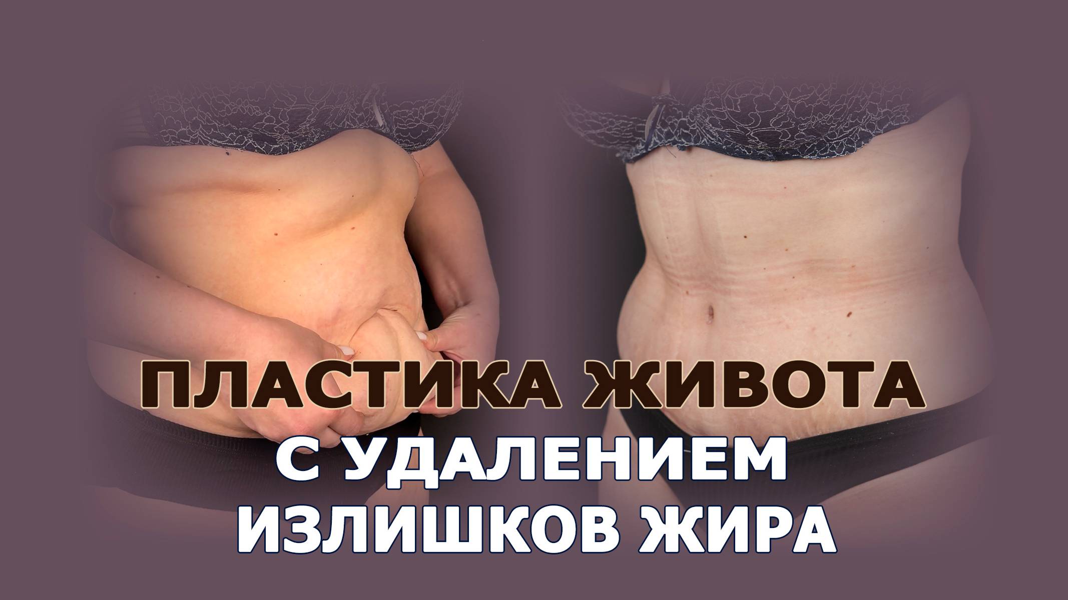 Липосакция и абдоминопластика: минус жировая ловушка