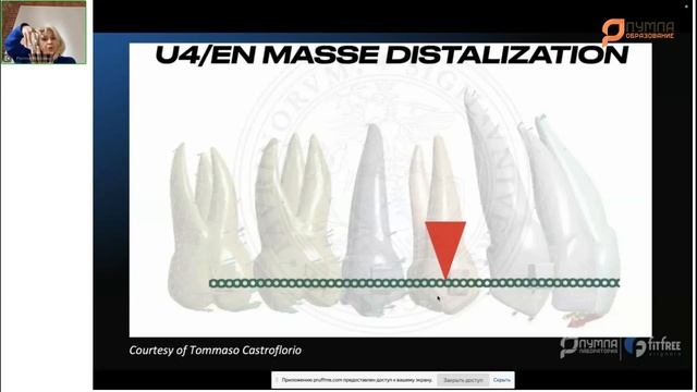 Как вылечить на элайнерах, чтобы потом не лечить сустав