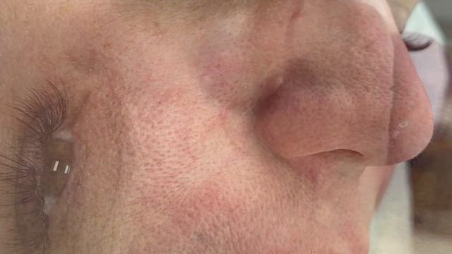 Результат Лечение Купероза с IPL