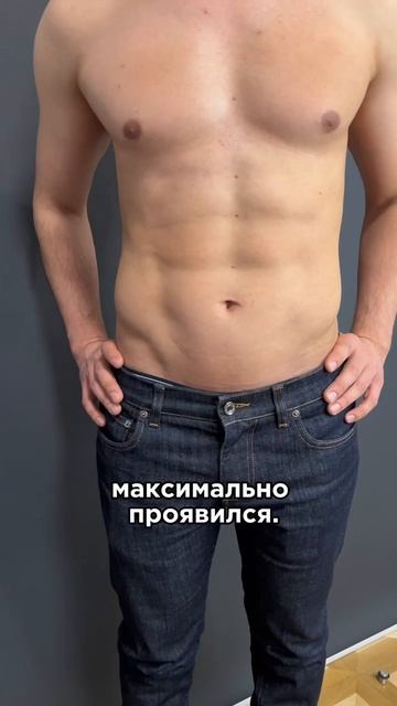 #липоскульптурирование: спустя 2 месяца